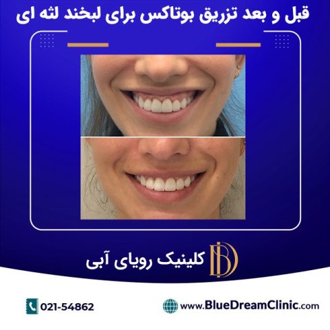 لبخند لثه ای یا گامی اسمایل چیست+بهترین راه درمان